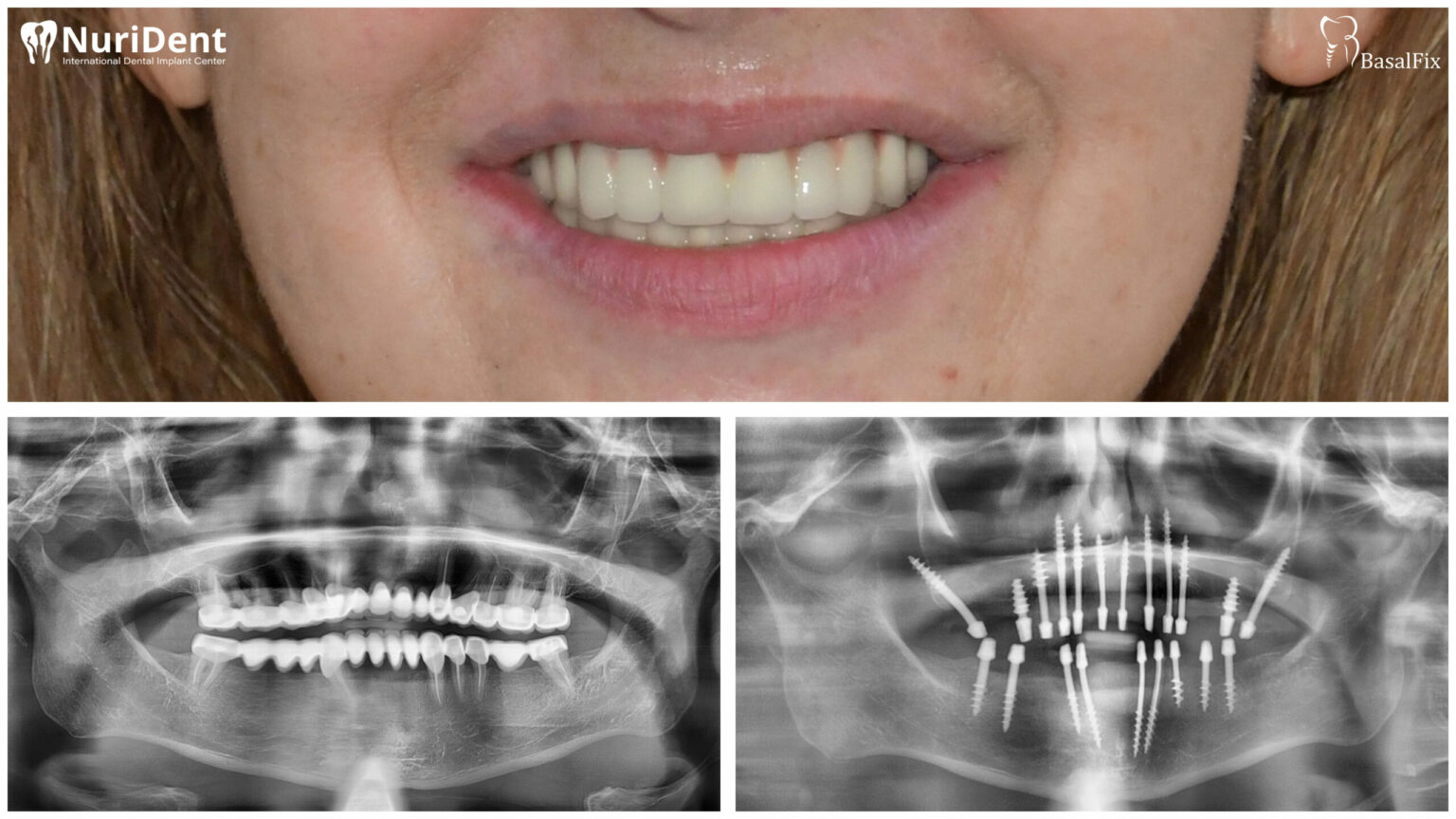 Clinical Cases – BASALFIX